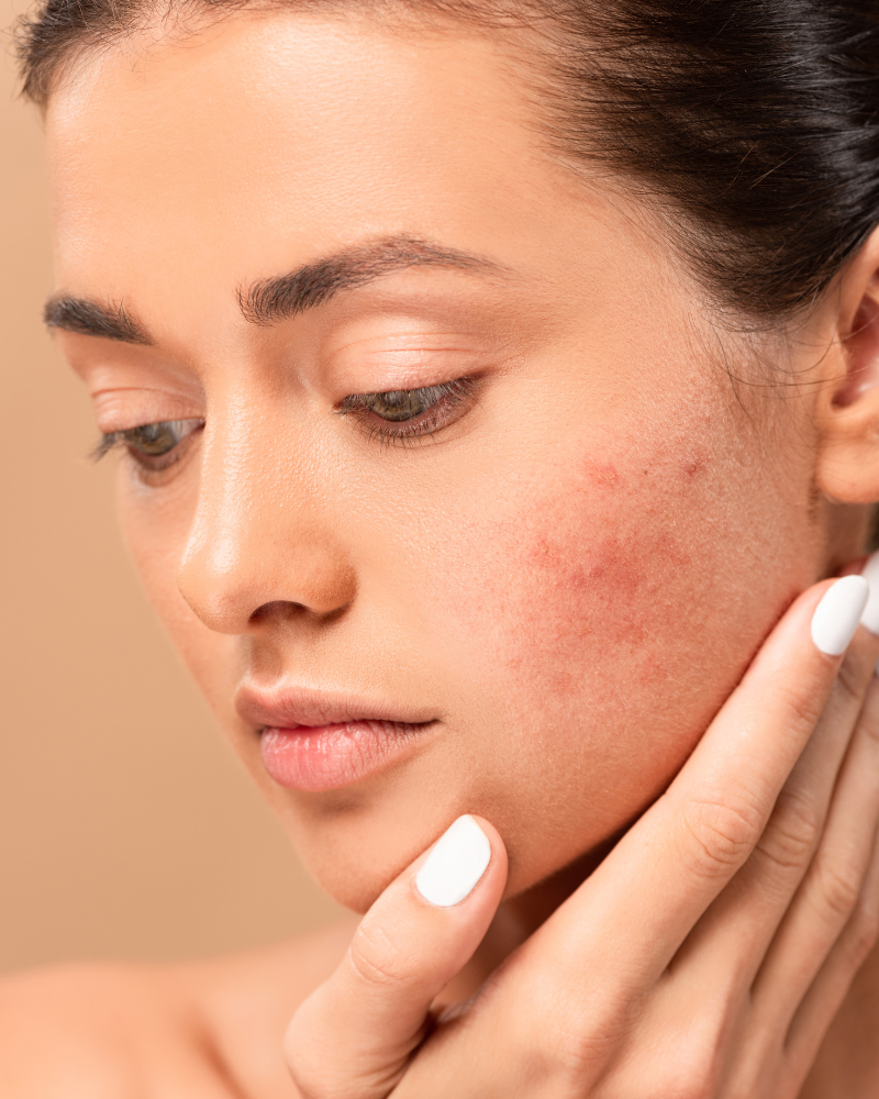 Macchie della pelle: cosa sono e come si curano - Blog Dermafutura